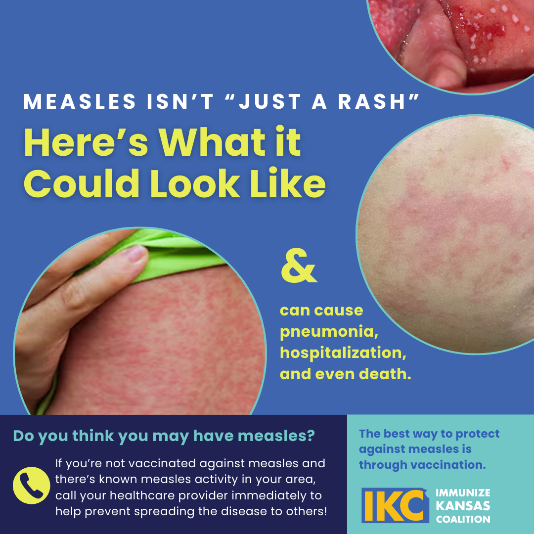 Measles | IKC